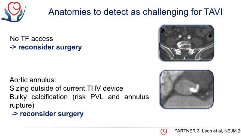 On lui propose un TAVI - | Cardio-online